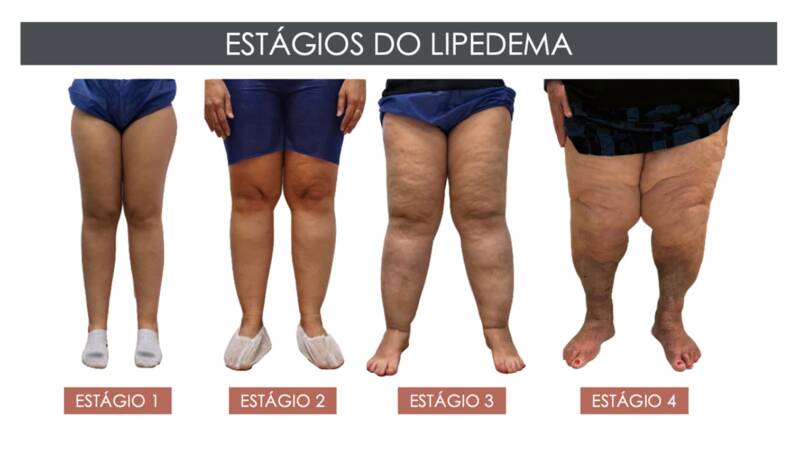 Lipedema – Dra. Mariana Barros